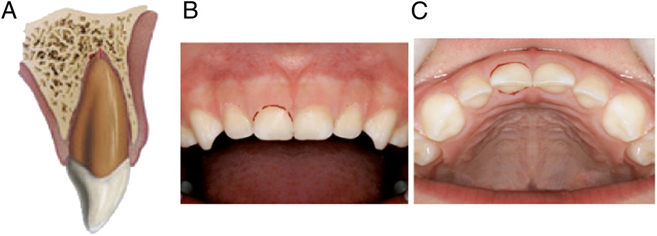 Non Fracture Teeth | Kid Focus Dentistry